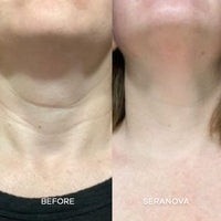 Offer: 3 Month | 6 Treatments