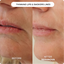 The Microneedling Infusion System™