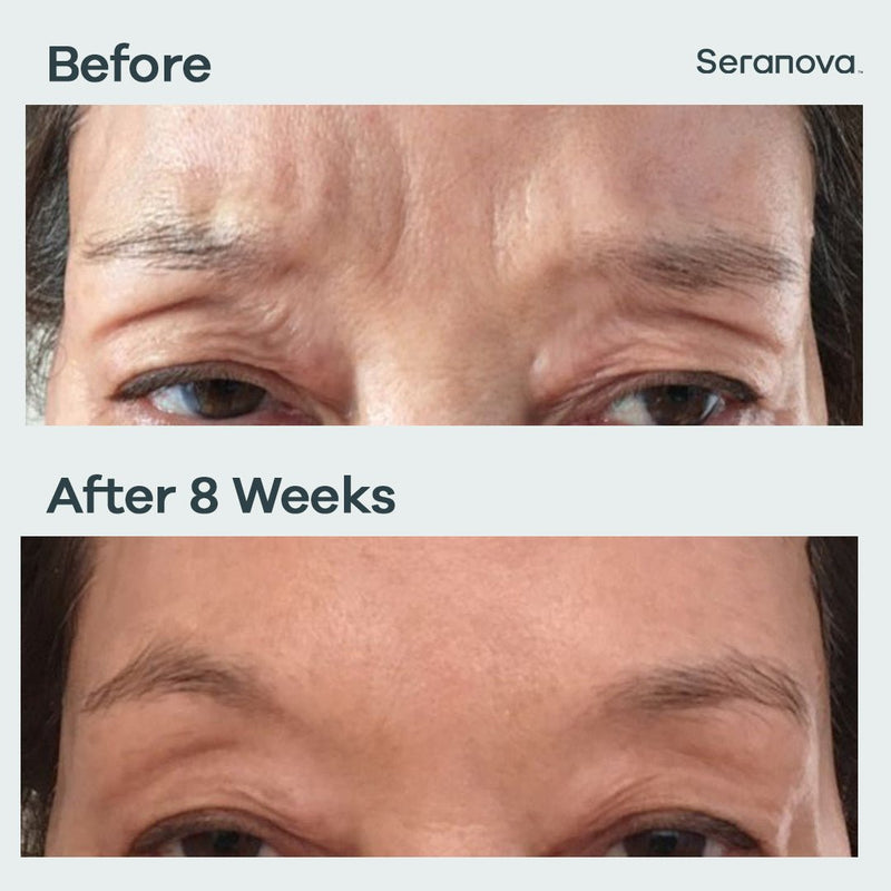 Targeted Micro Infusion Patches by Seranova