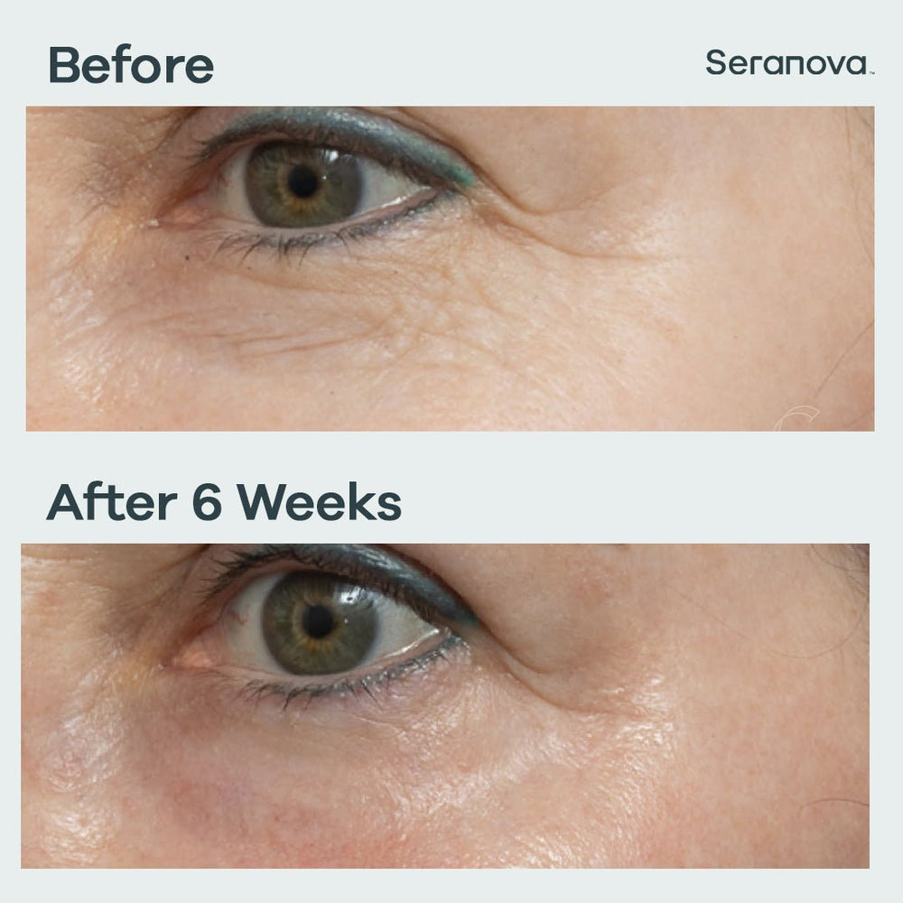 Targeted Micro Infusion Patches by Seranova