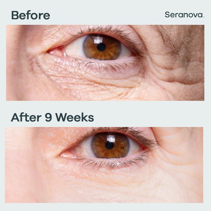 Targeted Micro Infusion Patches by Seranova