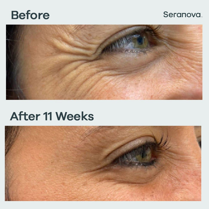 Targeted Micro Infusion Patches by Seranova